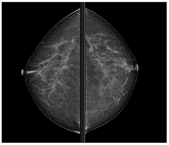 Breast Imaging Physics in Mammography (Part I)