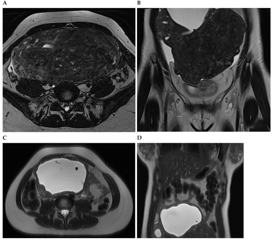 Hyaline and Cystic Degeneration of Uterine Leiomyomas: CT and MR ...