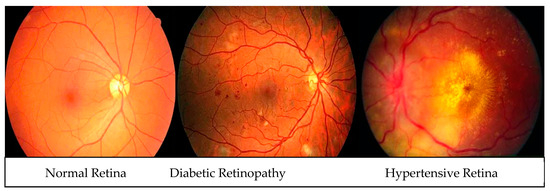 Diagnostics | Free Full-Text | HDR-EfficientNet: A Classification of Hypertensive and Diabetic ...