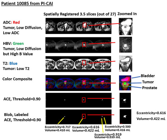 Diagnostics | Free Full-Text | Relationship between Eccentricity and Volume Determined by ...
