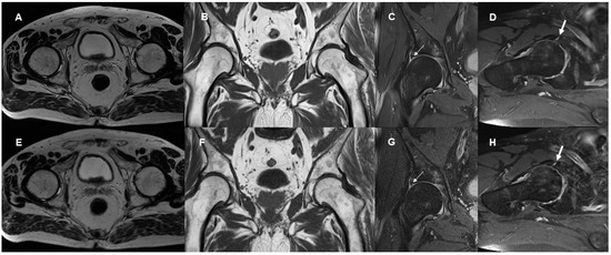 Image Quality and Diagnostic Performance of Accelerated 2D Hip MRI with ...