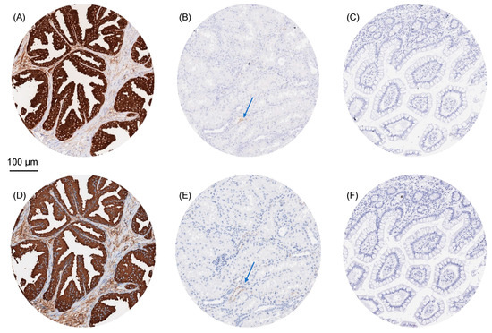 Diagnostics | Free Full-Text | Diagnostic Role and Prognostic Impact of ...