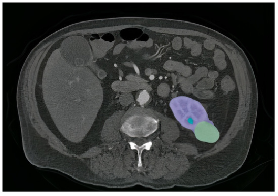 Optimizing Inference Distribution for Efficient Kidney Tumor ...