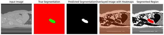 Optimizing Inference Distribution for Efficient Kidney Tumor Segmentation Using a UNet-PWP Deep ...