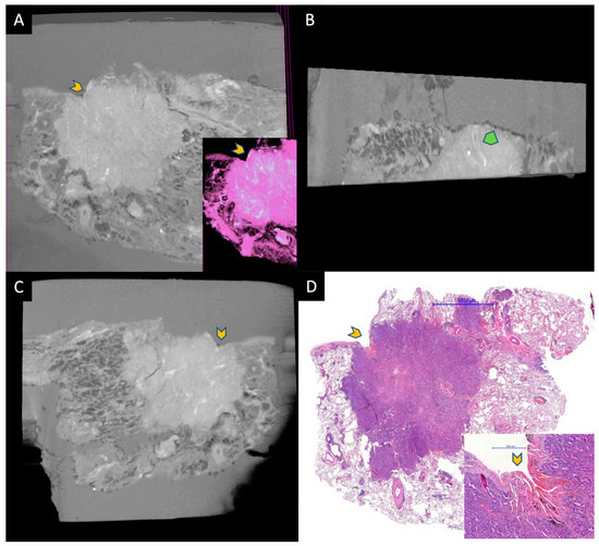 The Value of Micro-CT in the Diagnosis of Lung Carcinoma: A Radio ...