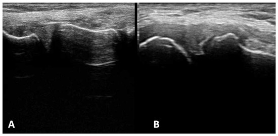 The Value of Ultrasound Diagnostic Imaging of Meniscal Knee Injuries ...