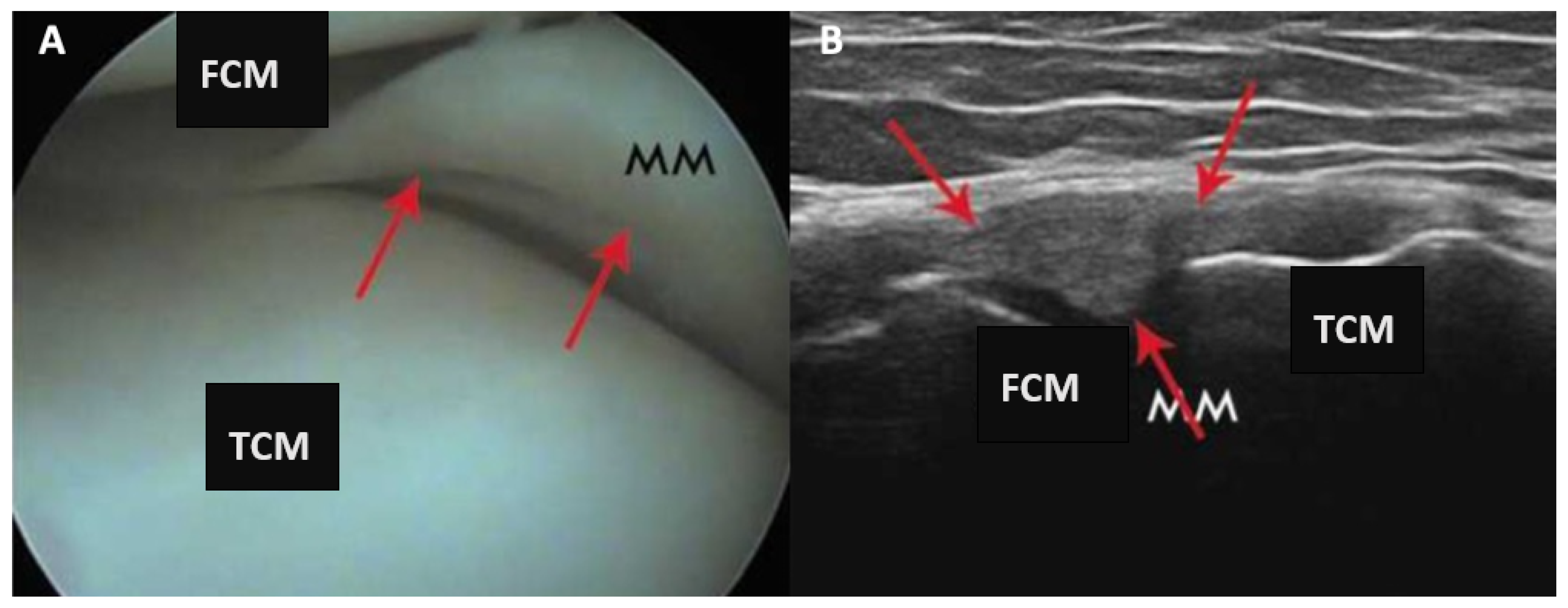The Value of Ultrasound Diagnostic Imaging of Meniscal Knee Injuries ...