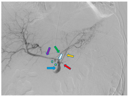 Use of Transradial Access to Install Two Sequential Stents for ...