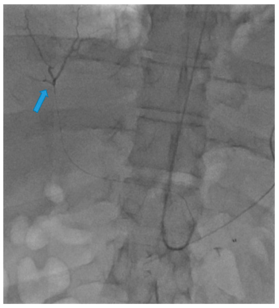 Use of Transradial Access to Install Two Sequential Stents for ...