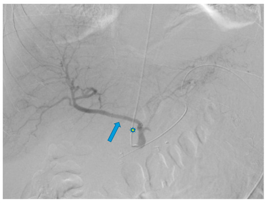 Use of Transradial Access to Install Two Sequential Stents for ...