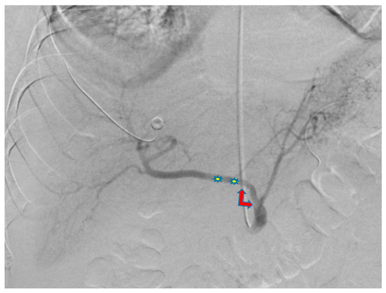 Use of Transradial Access to Install Two Sequential Stents for ...