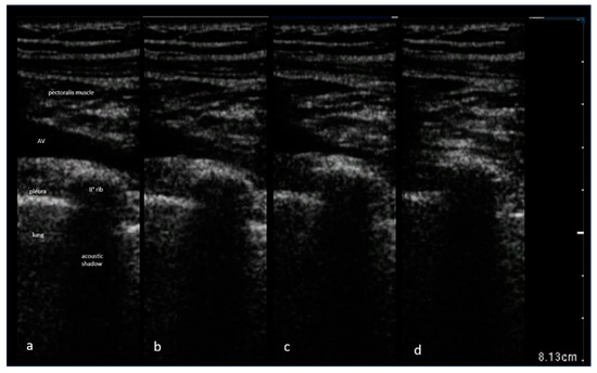 Feasibility of Ultrasound-Guided Axillary Vein Puncture under Valsalva ...
