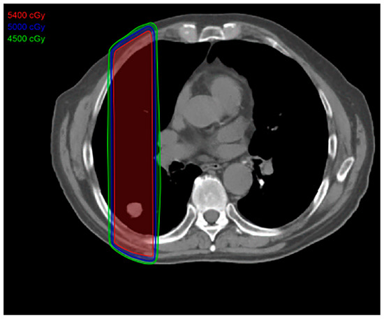 Spectrum of Imaging Patterns of Lung Cancer following Radiation Therapy