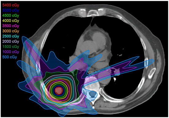 Spectrum of Imaging Patterns of Lung Cancer following Radiation Therapy