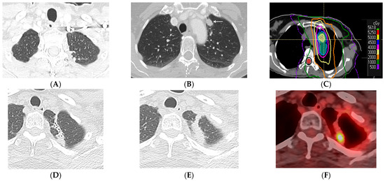 Spectrum of Imaging Patterns of Lung Cancer following Radiation Therapy