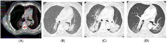 Diagnostics | Free Full-Text | Spectrum of Imaging Patterns of Lung ...