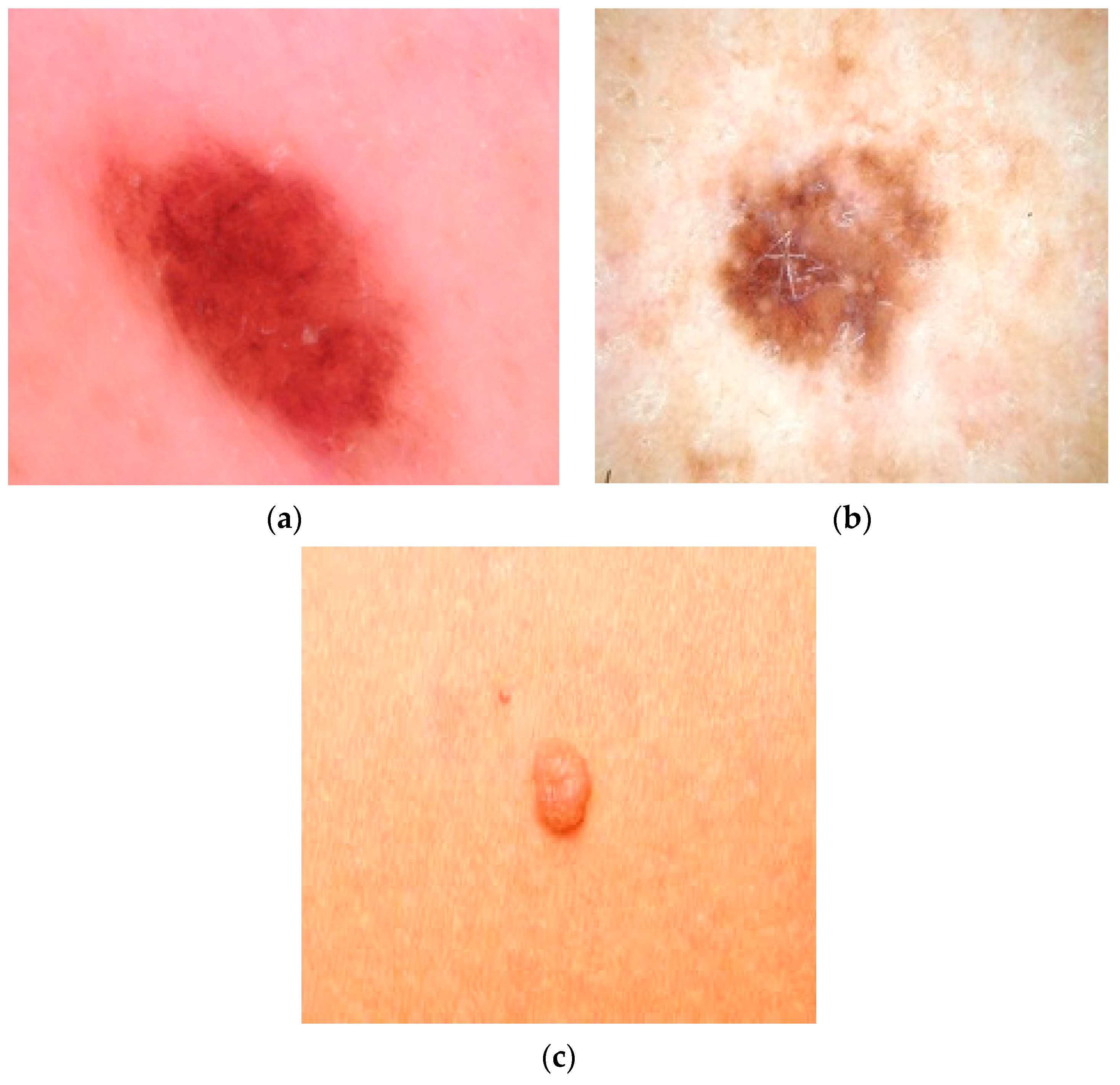 Detection and Classification of Melanoma Skin Cancer Using Image ...
