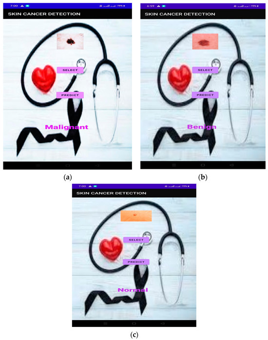 Detection and Classification of Melanoma Skin Cancer Using Image ...