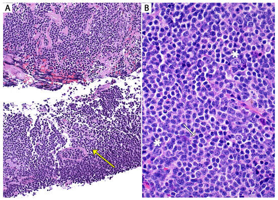 Diagnostic Approach to Pulmonary B-Cell Lymphomas in Small Biopsies ...
