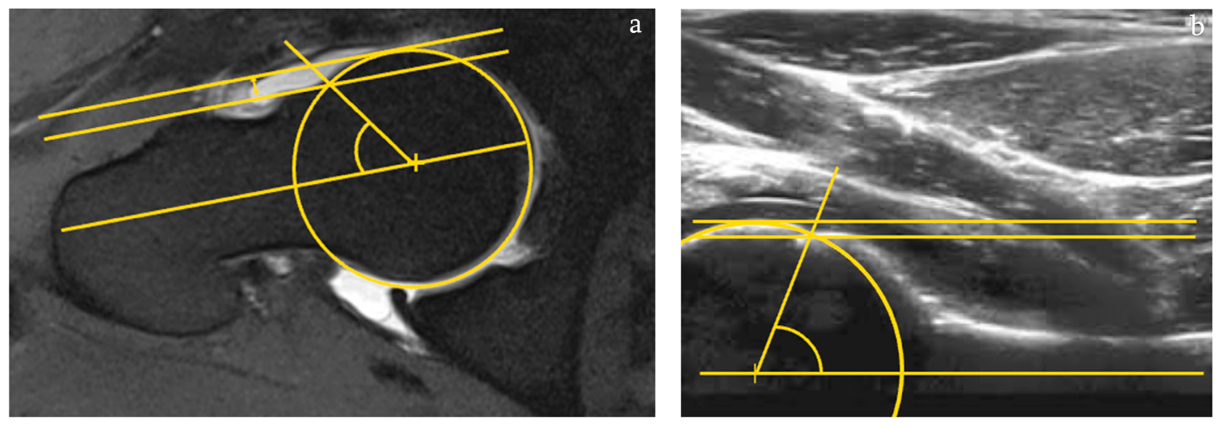 Association of Chondrolabral Lesions with Ultrasound-Guided Detection ...