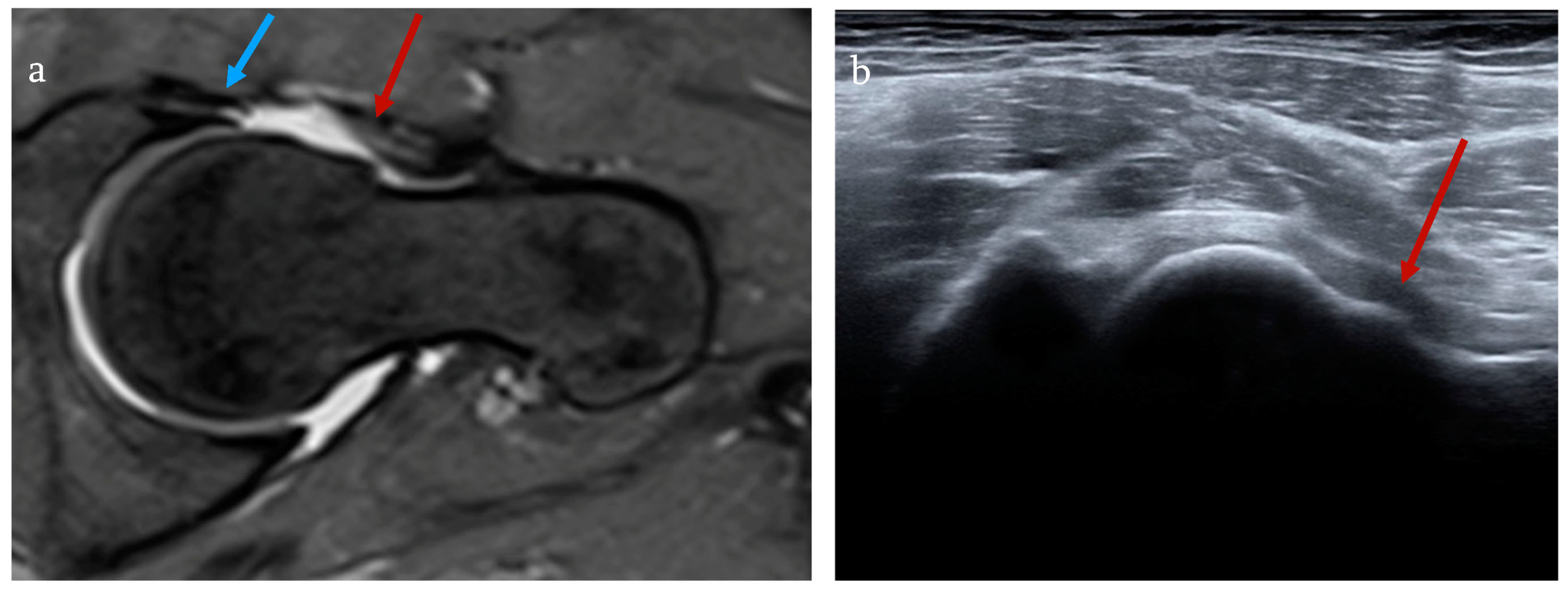 Diagnostics | Free Full-Text | Association of Chondrolabral Lesions ...