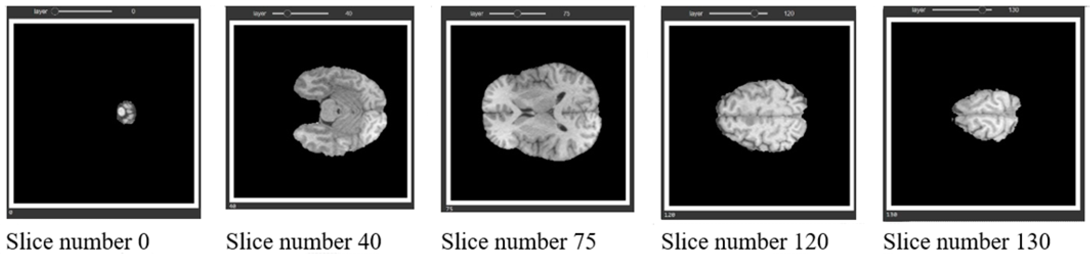 Diagnostics | Free Full-Text | Segmentation of Brain Tumor Using a 3D Generative Adversarial Network