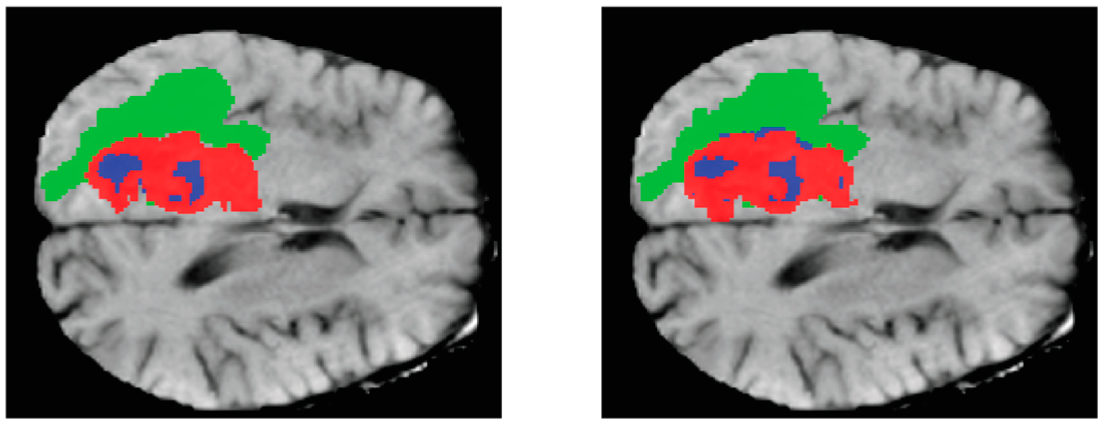 Diagnostics | Free Full-Text | Segmentation of Brain Tumor Using a 3D ...