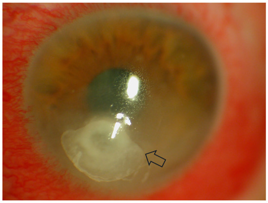 Updates in Diagnostic Imaging for Infectious Keratitis: A Review