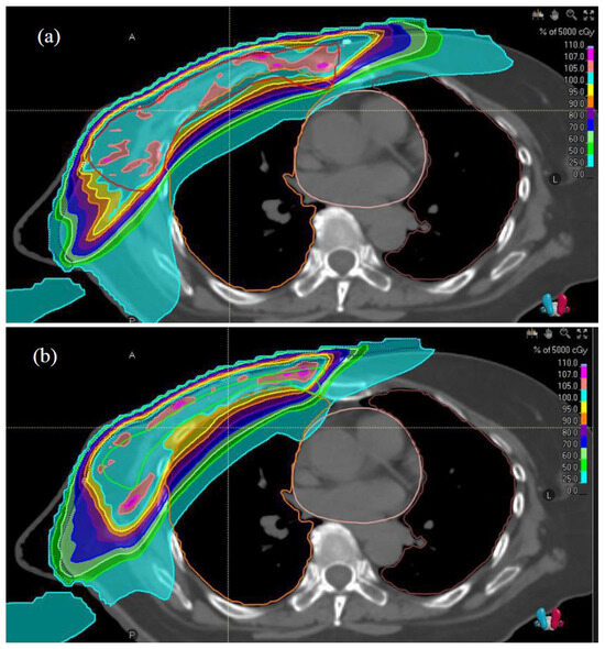 Comparative Study of Plan Robustness for Breast Radiotherapy ...