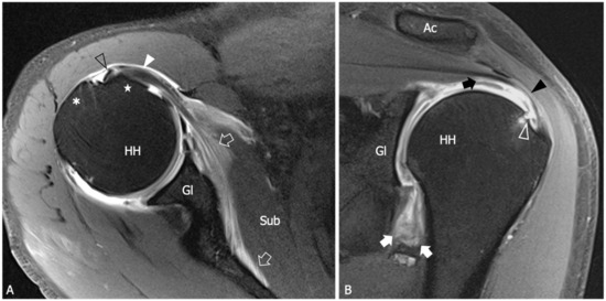 Diagnostics | Free Full-Text | Adhesive Capsulitis of the Shoulder ...
