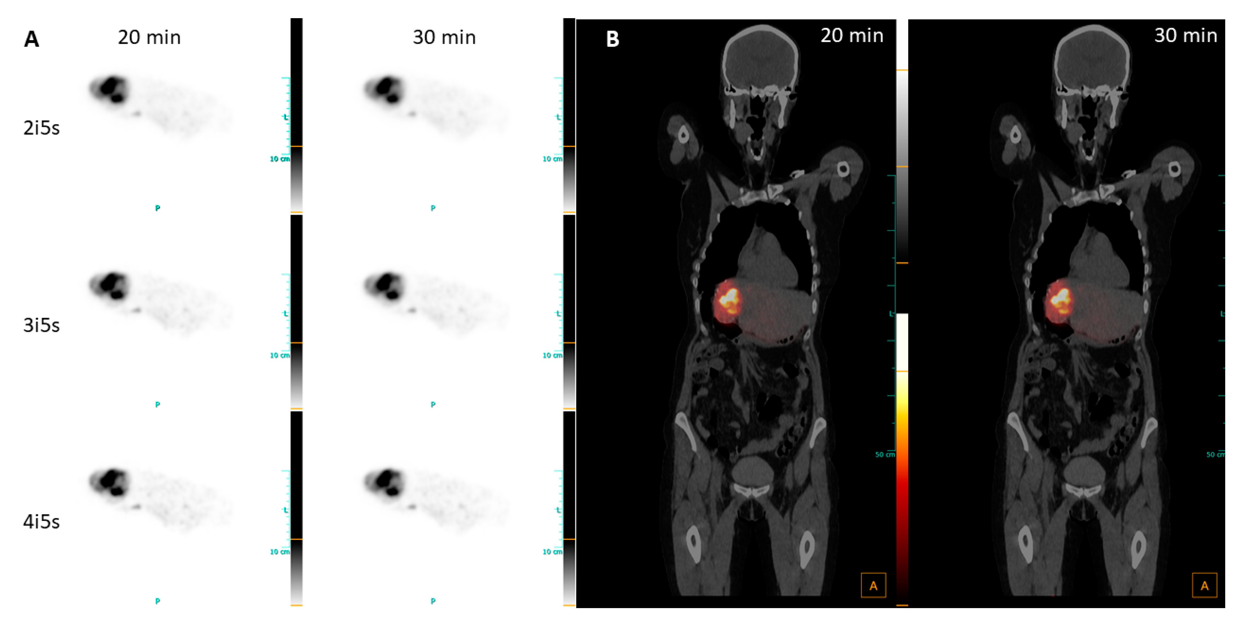 Optimization of Y-90 Radioembolization Imaging for Post-Treatment Dosimetry on a Long Axial ...