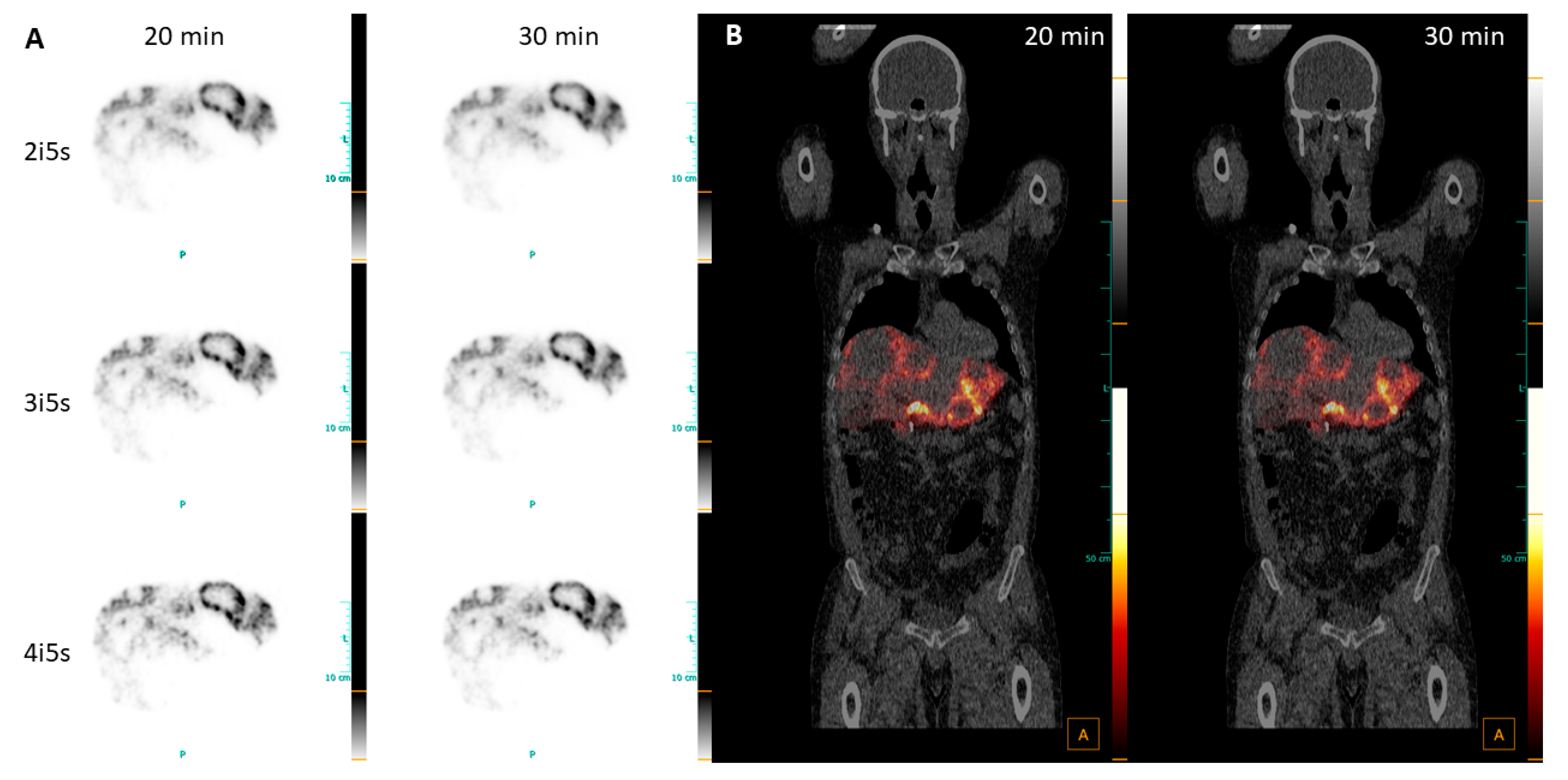 Optimization of Y-90 Radioembolization Imaging for Post-Treatment ...