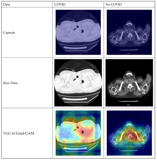 Cloud-Based Quad Deep Ensemble Framework for the Detection of COVID-19 ...