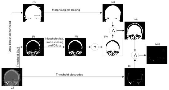 MRI and CT Fusion in Stereotactic Electroencephalography (SEEG)