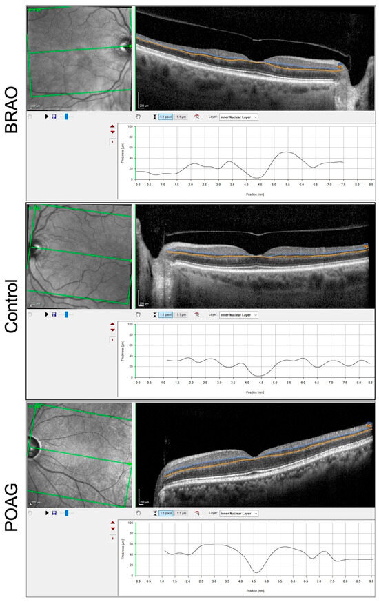 Inner Retinal Thinning Comparison between Branch Retinal Artery ...