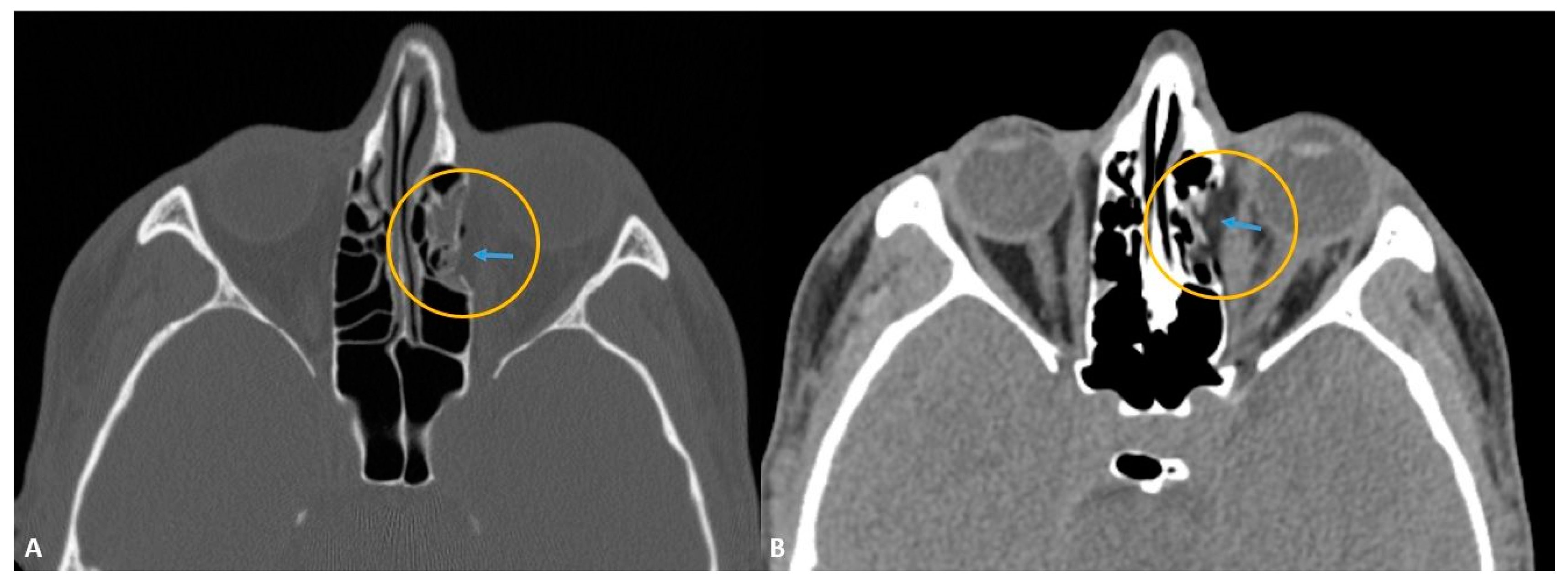 A Comprehensive Look at Maxillofacial Traumas: On the Basis of Orbital ...