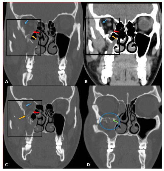 A Comprehensive Look at Maxillofacial Traumas: On the Basis of Orbital ...
