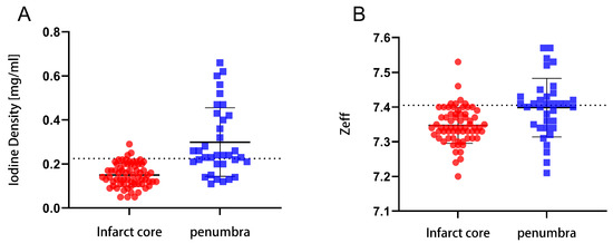 Nomogram Based on Dual-Layer Spectral Detector CTA Parameter for the Prediction of Infarct Core ...