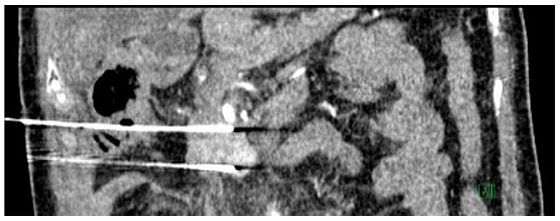 Sequential Irreversible Electroporation for Locally Advanced Pancreatic ...