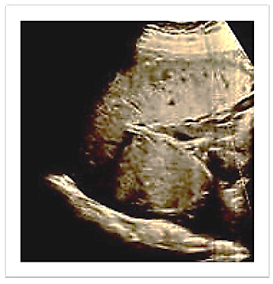 Surgical Conservative Management of a Retained Placenta after Angular ...