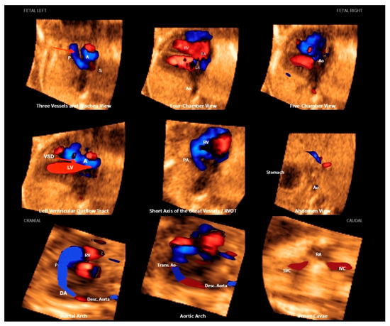Evolution of Fetal Cardiac Imaging over the Last 20 Years