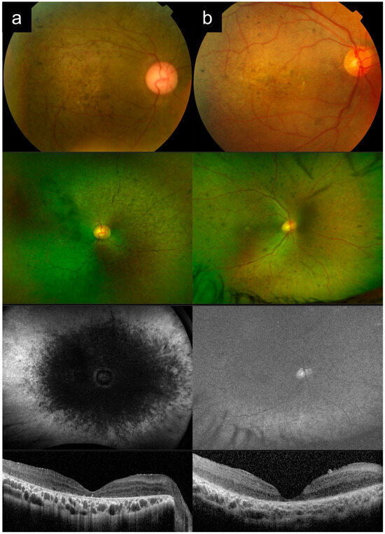 Diagnostic Challenges in ABCA4-Associated Retinal Degeneration: One ...