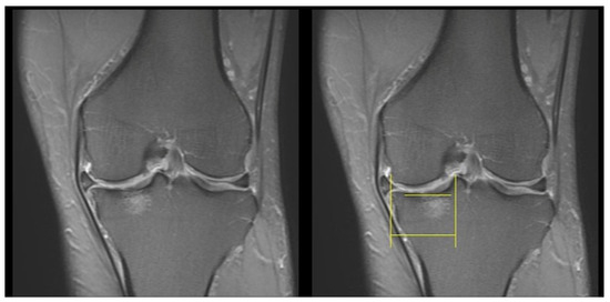 Correlation between Subchondral Insufficiency Fracture of the Knee and ...