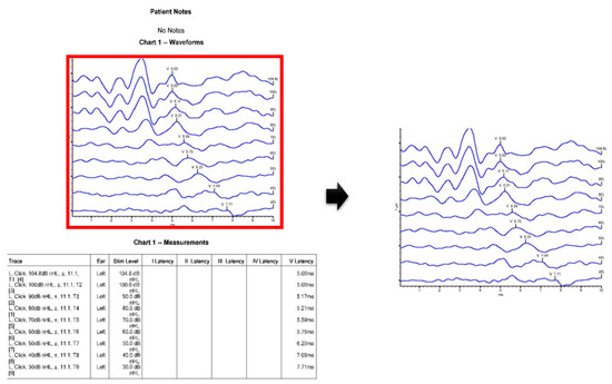 Diagnostics | Free Full-Text | Auditory Brainstem Response Data Preprocessing Method for the ...