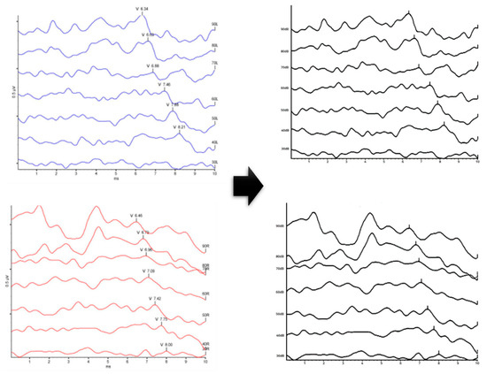 Diagnostics | Free Full-Text | Auditory Brainstem Response Data Preprocessing Method for the ...