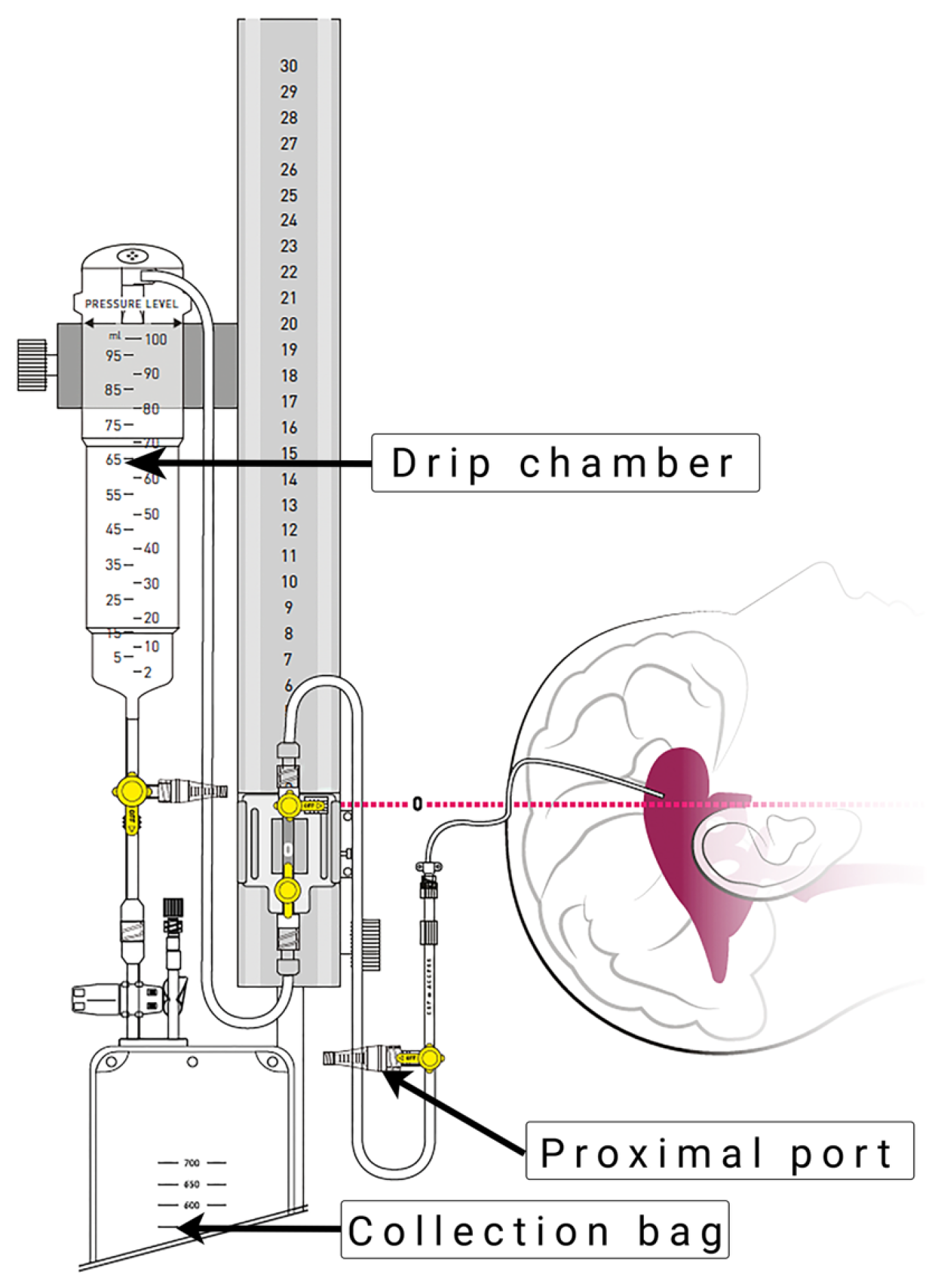 Diagnostics | Free Full-Text | Where to Draw Cerebrospinal Fluid from an External Ventricular ...