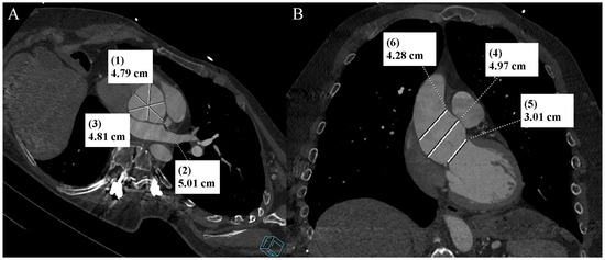 Coexistence of Ehlers–Danlos Syndrome with Coronary–Pulmonary Arterial ...