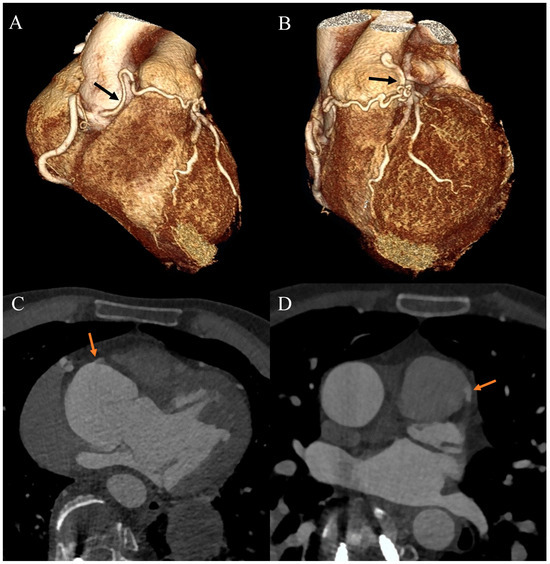 Coexistence of Ehlers–Danlos Syndrome with Coronary–Pulmonary Arterial ...