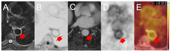 Magnetic Resonance Imaging Findings Corresponding to Vasculitis as ...
