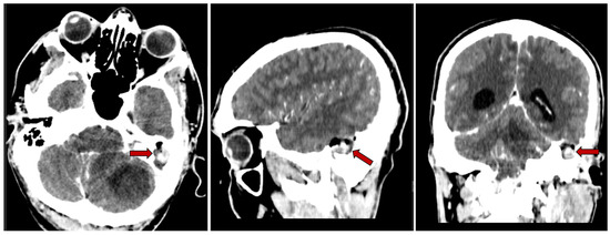 Cerebellar Abscess Secondary to Cholesteatomatous Otomastoiditis—An Old ...